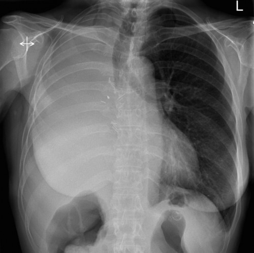 Left lower lobe collapse - CXR - Radiology at St. Vincent's University ... Left lower lobe collapse - CXR - Radiology at St. Vincent's University ...