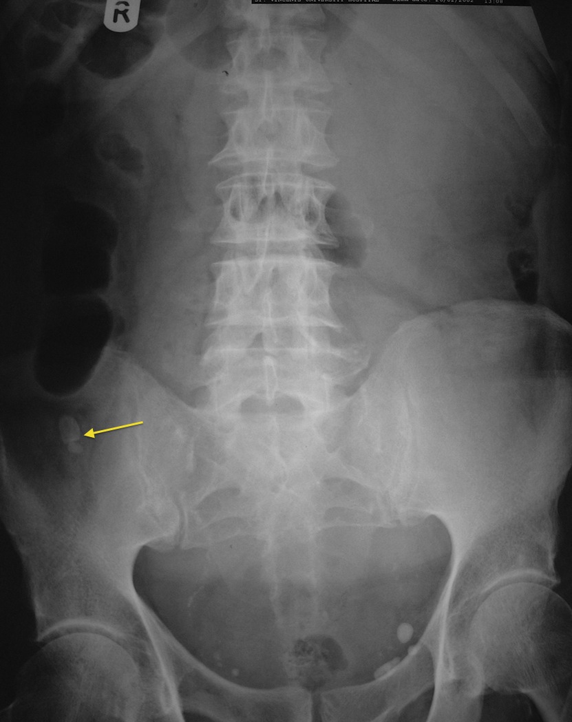 Appendicolith Radiology At St Vincents University Hospital