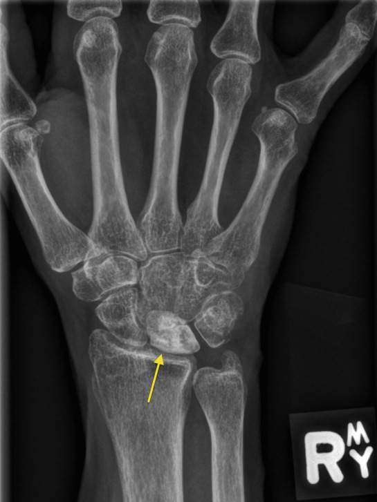 Avascular necrosis – lunate - Radiology at St. Vincent's University ... Avascular necrosis – lunate - Radiology at St. Vincent's University ...