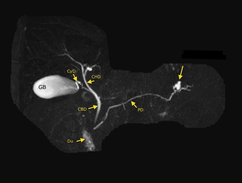 What Is A Mri With Mrcp At Rebecca Skinner Blog