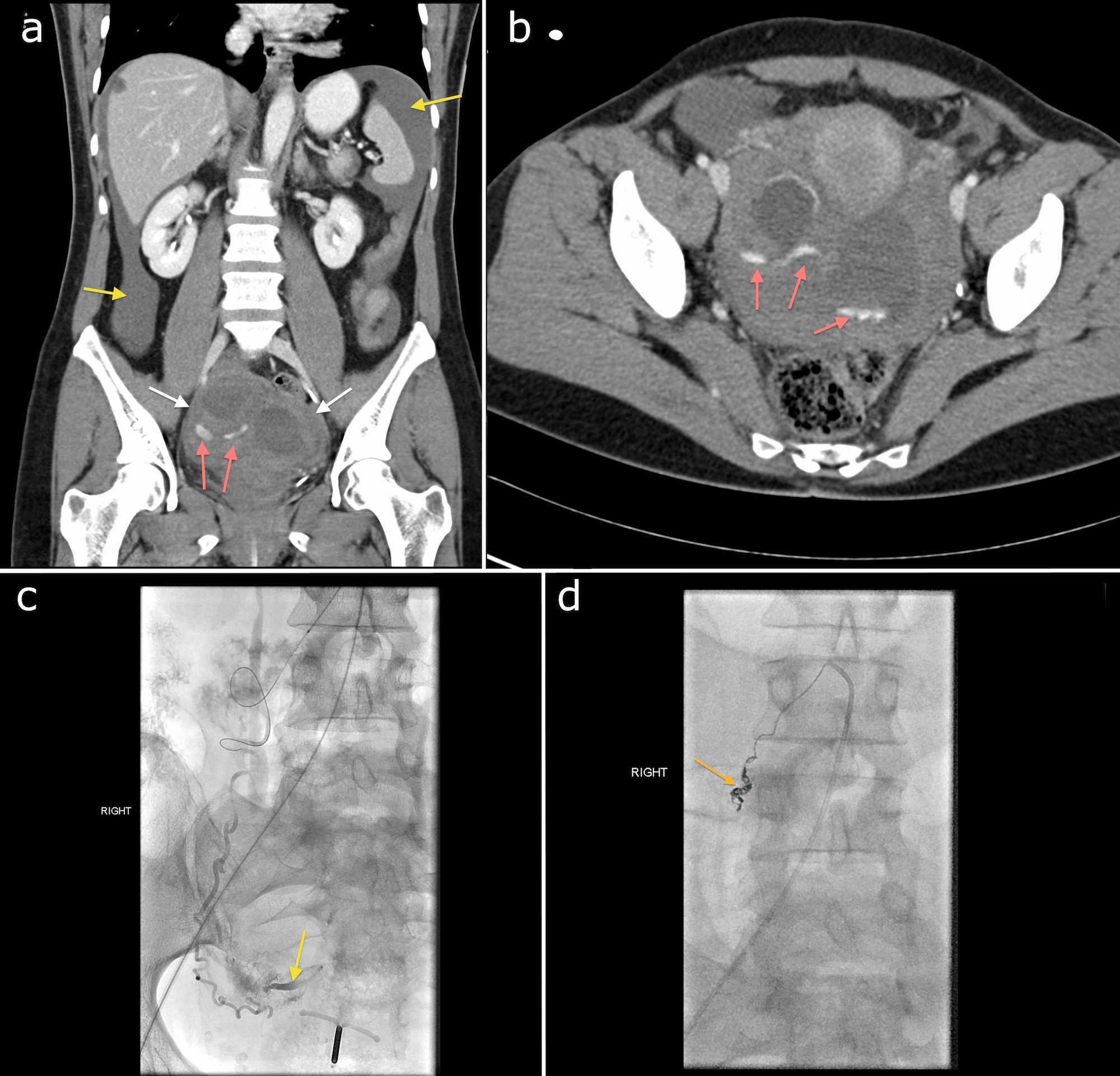 Pelvic Embolization Radiology At St Vincents University Hospital