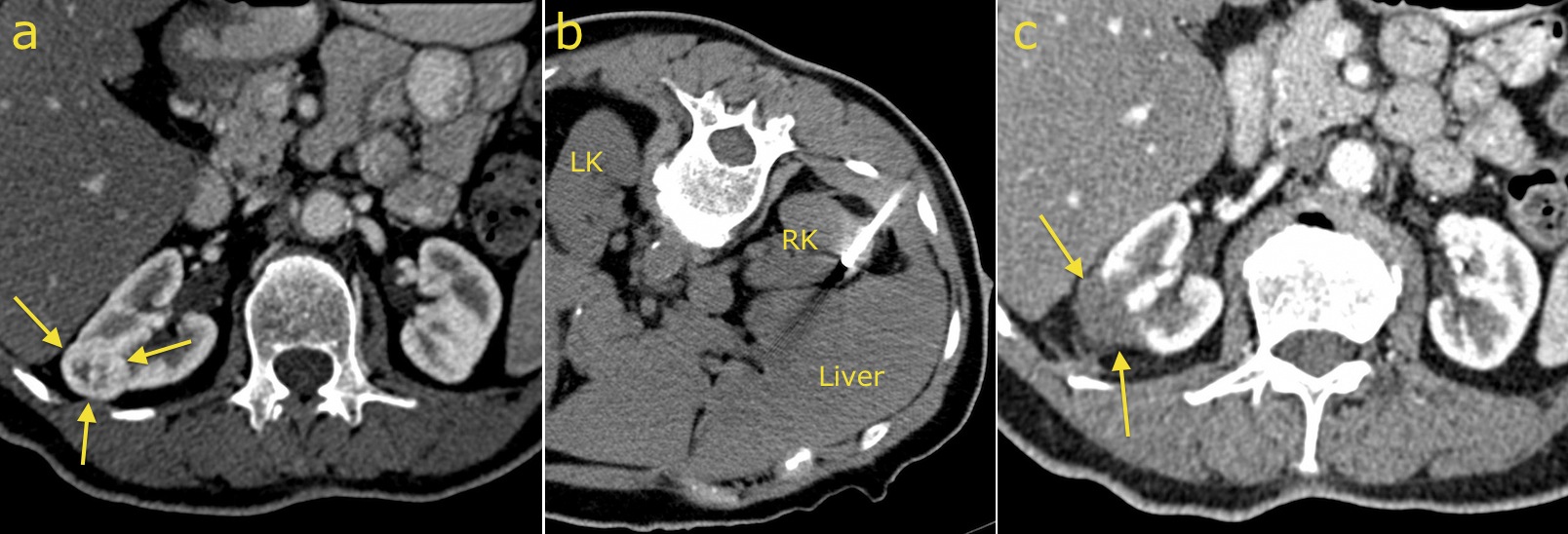 Radiofrequency Ablation Rcc Radiology At St Vincents University