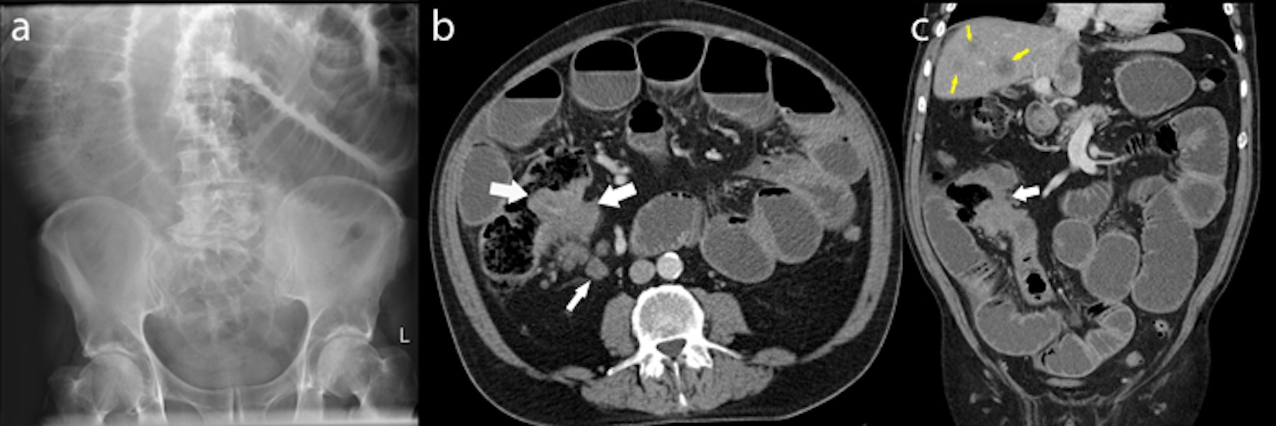 Obstructing Caecal Carcinoma Radiology At St Vincents University