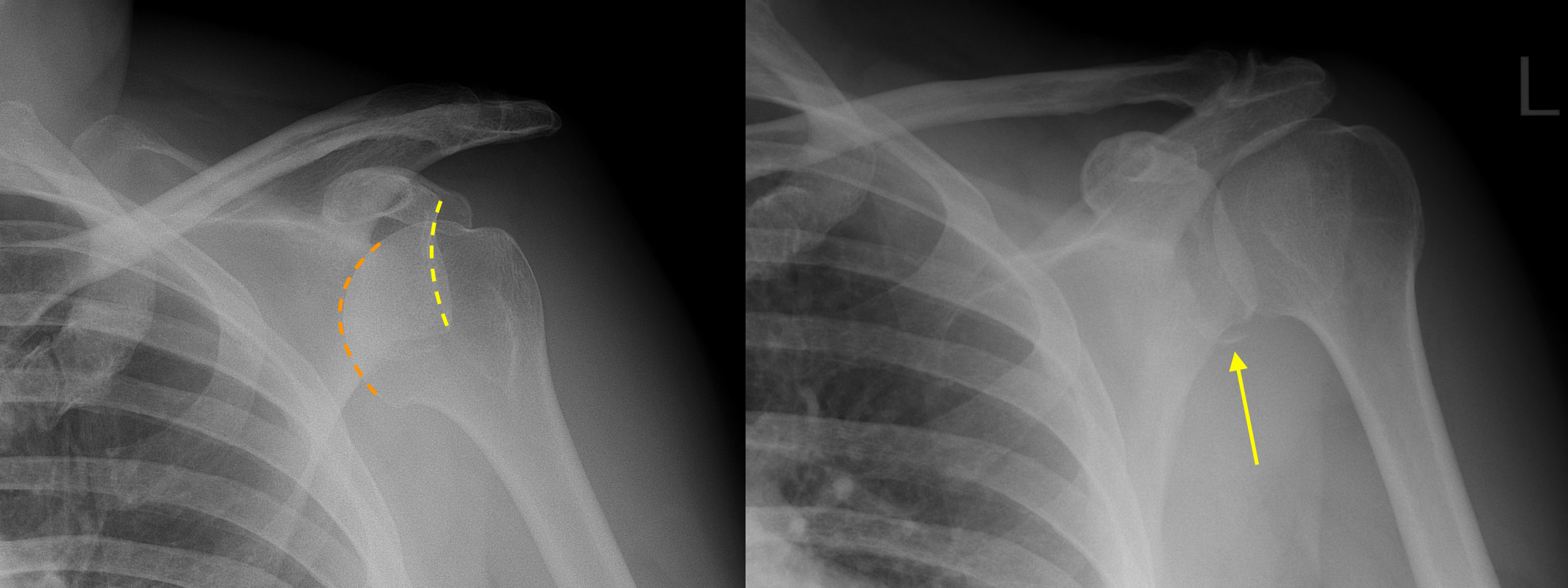 Posterior Shoulder Dislocation X Ray Radiology at Rhonda Carter blog Posterior Shoulder Dislocation X Ray Radiology at Rhonda Carter blog
